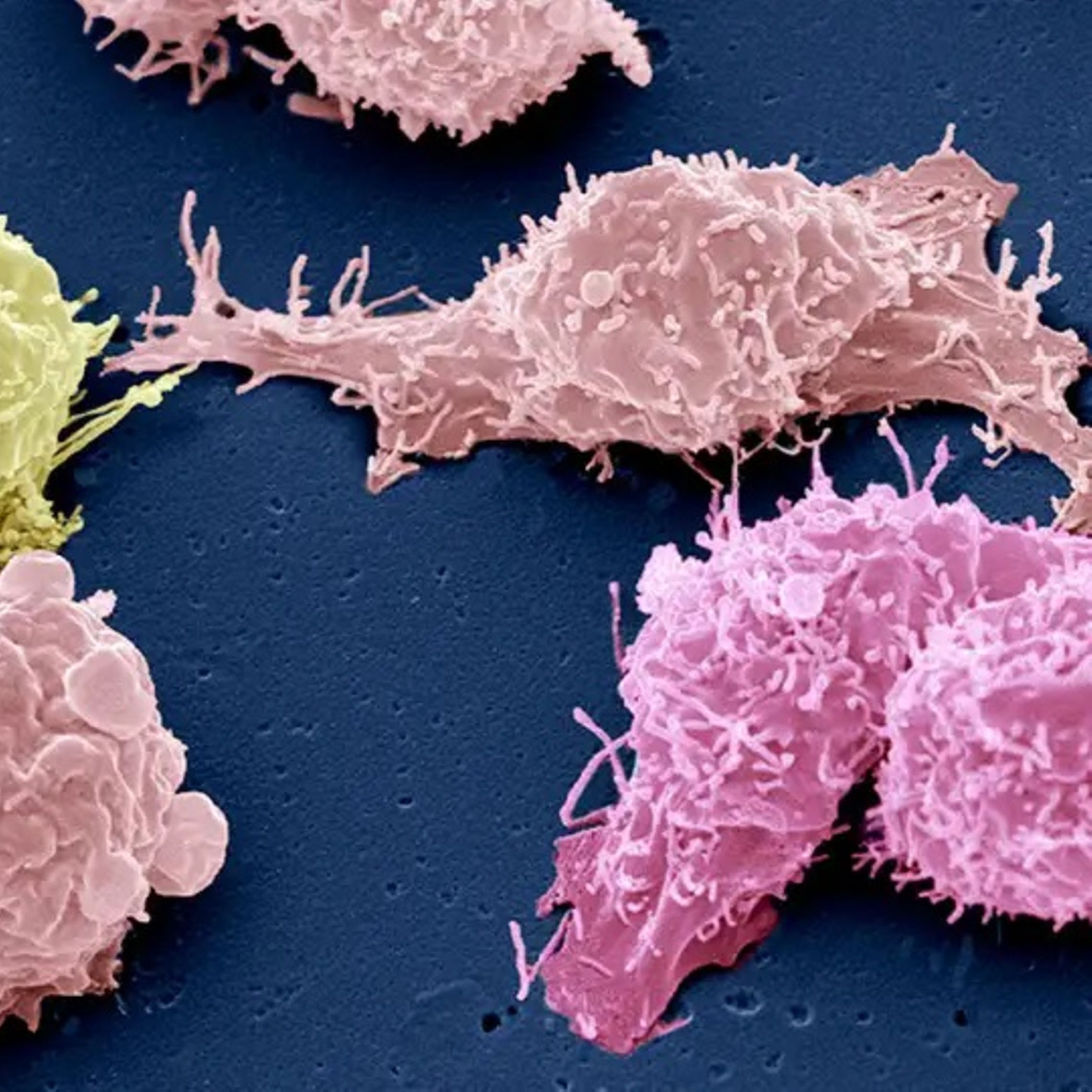 Harnessing Neoantigens for Individualized Cancer Immunotherapy Webinar ...